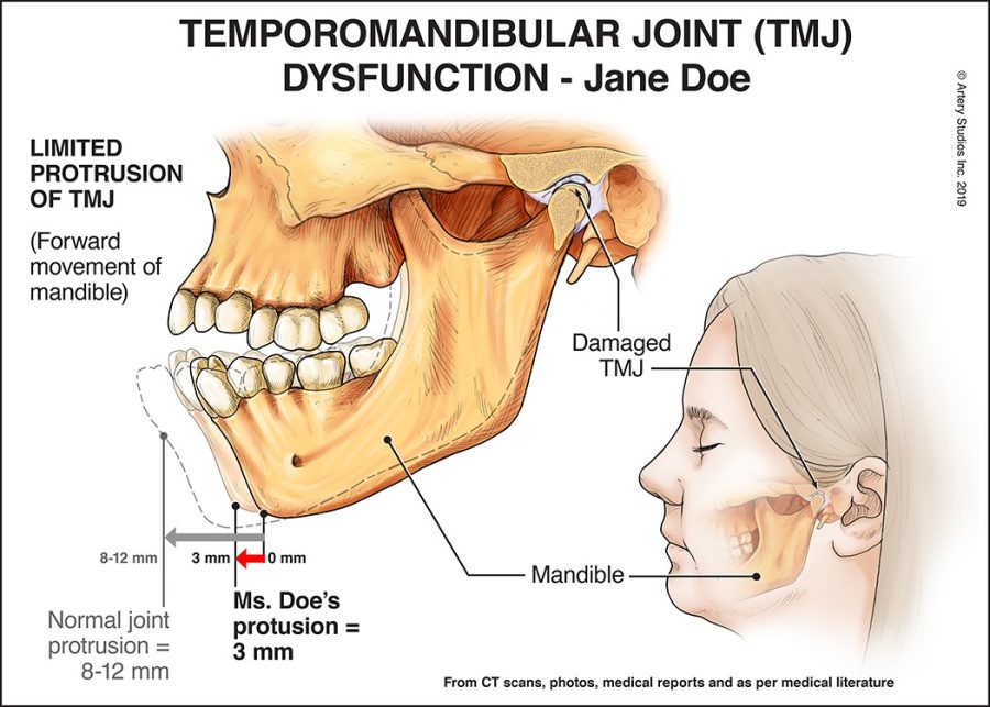 Complications from TMJ Trauma - Artery Studios