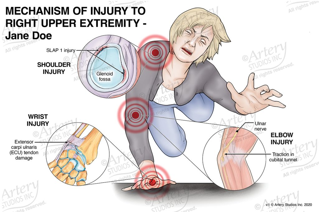 Slip and Fall Injury Illustrations & Animations | Artery Studios